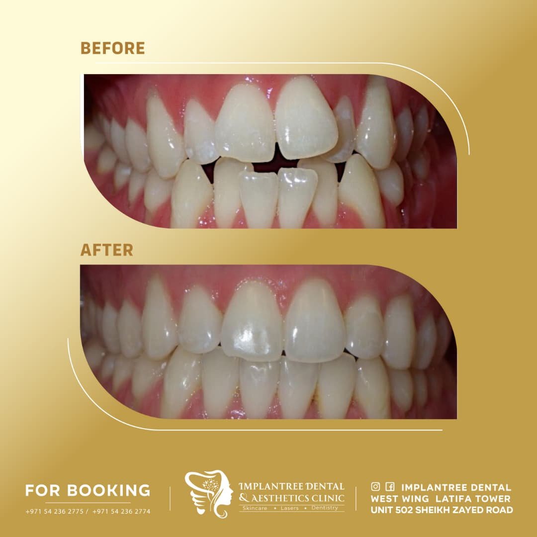Invisalign Treatment in Dubai | Implantree Clinic